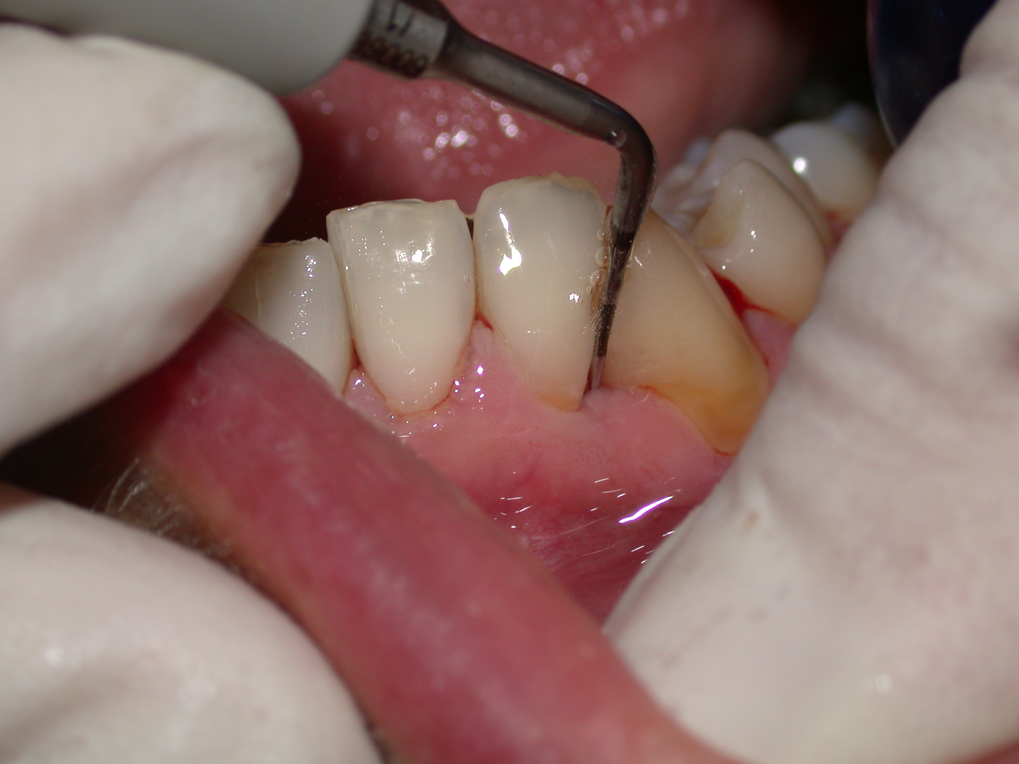 Come è cambiata la terapia parodontale non chirurgica